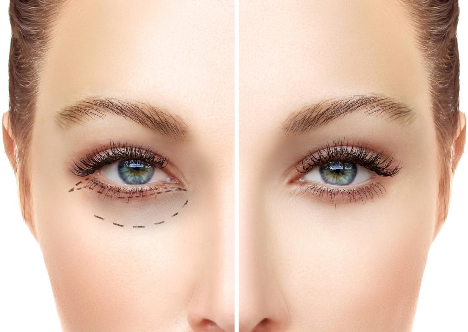 So you’re considering… Peri-orbital or eyelid surgery - Fuan Chan ...